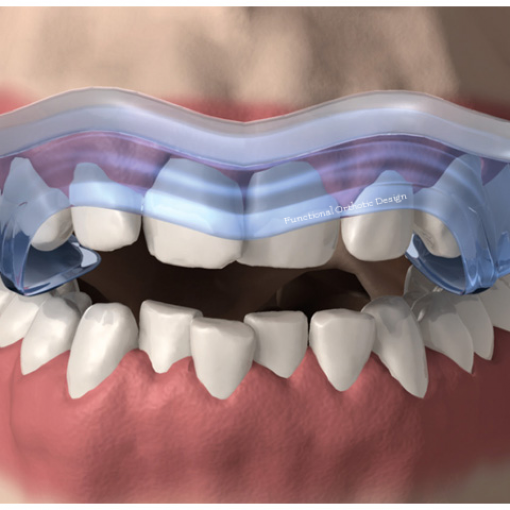 Aqualizer | functional orthoticdesign