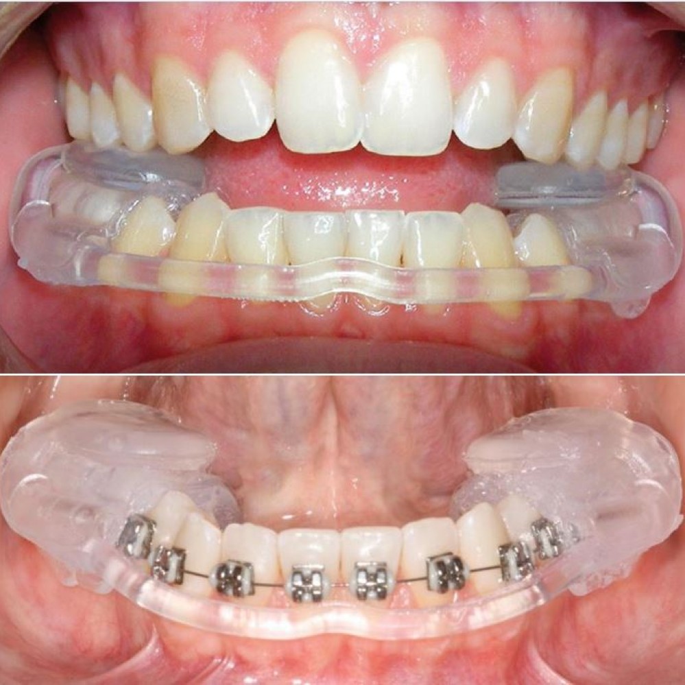 AquaSplint | functional orthoticdesign